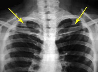 Congenital Abnormalities, Cervical Ribs, and Related Bony Abnormalities ...