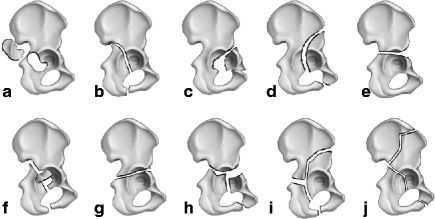 Pelvis and Lower Limb | SpringerLink