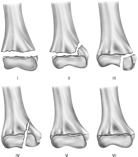 Fractures in Children | SpringerLink