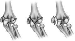 Fractures in Children | SpringerLink