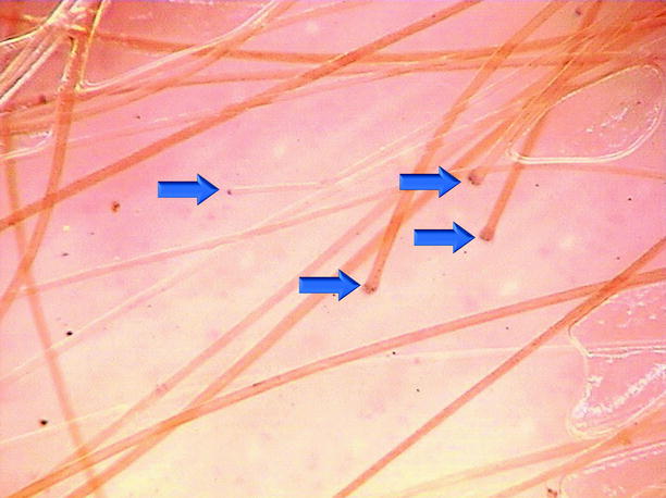 Trichorrhexis Nodosa | SpringerLink