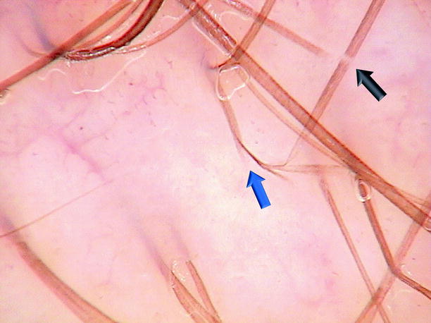 Trichorrhexis Nodosa | SpringerLink