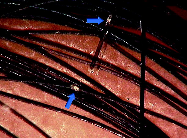 Trichorrhexis Nodosa | SpringerLink