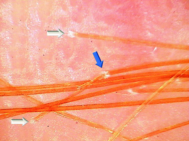 Trichorrhexis Nodosa | SpringerLink