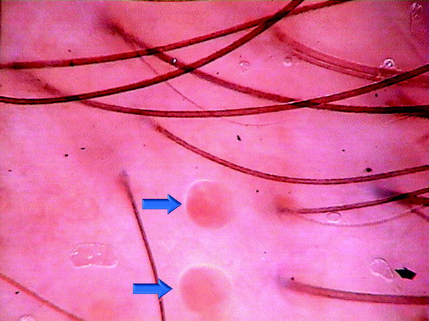 Telogen Effluvium | SpringerLink