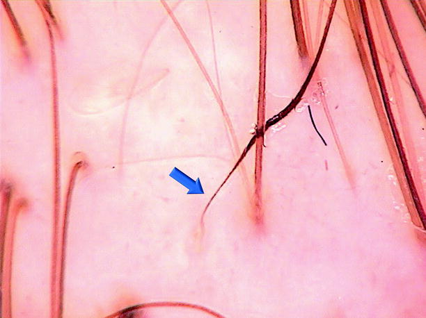 Hair Shafts | SpringerLink