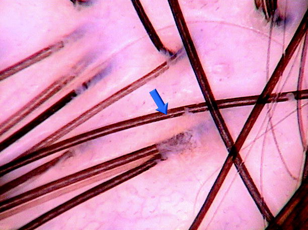 Hair Shafts | SpringerLink