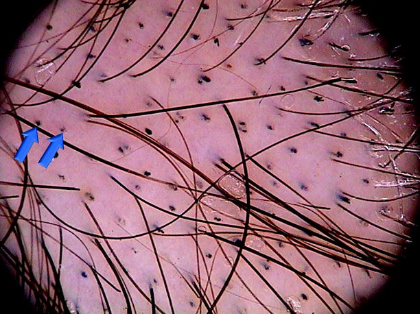 Hair Follicle Openings: Dots | SpringerLink