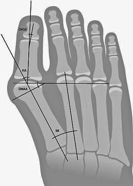 The Reverdin-Isham Procedure for the Correction of Hallux Valgus: A ...