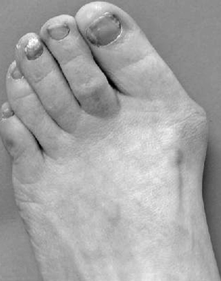 The Reverdin-Isham Procedure for the Correction of Hallux Valgus: A ...