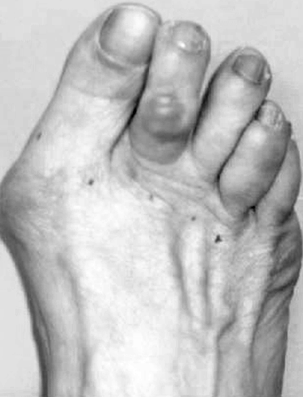 The Reverdin-Isham Procedure for the Correction of Hallux Valgus: A ...