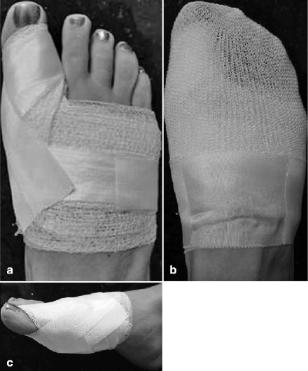 The Reverdin-Isham Procedure for the Correction of Hallux Valgus: A ...