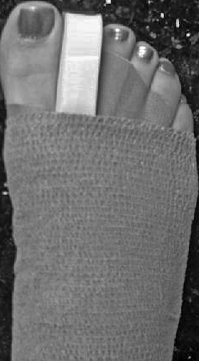 The Reverdin-Isham Procedure for the Correction of Hallux Valgus: A ...