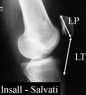 Patella Infera and Patella Alta | SpringerLink