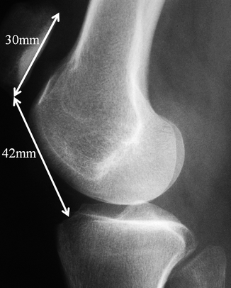 Patella Infera and Patella Alta | SpringerLink