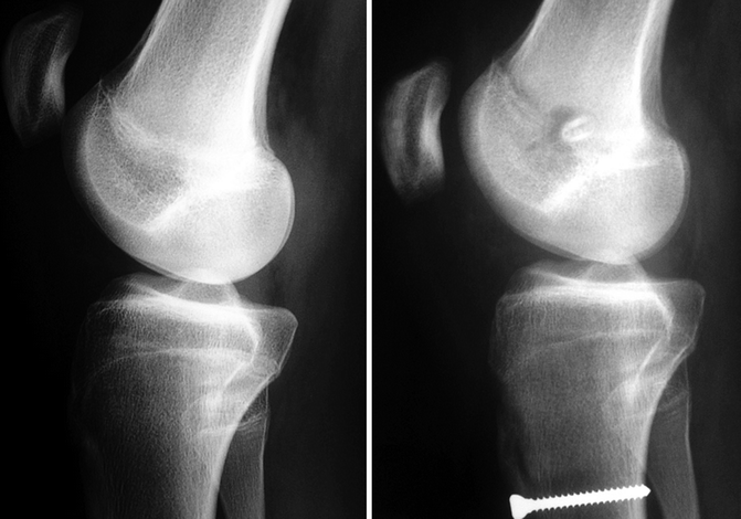 Patella Infera and Patella Alta | SpringerLink