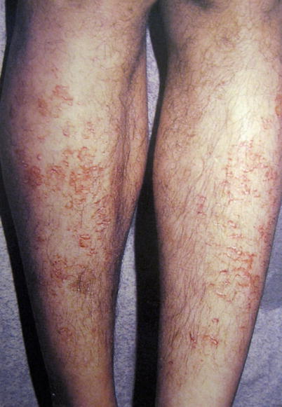 Xerosis | SpringerLink