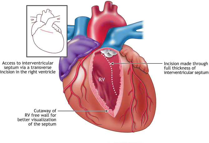 Sub-aortic Stenosis | SpringerLink