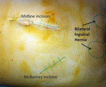 Laparoscopic Inguinal Hernia Repair: TAPP | SpringerLink