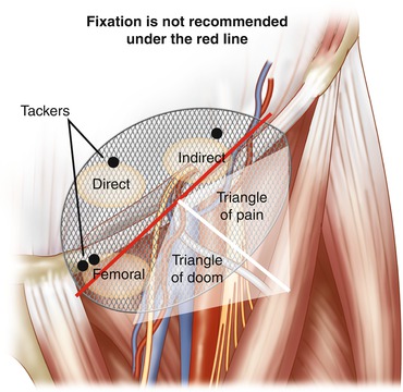 Prostheses Fixation During Laparoscopic Inguinal Hernia Repair ...