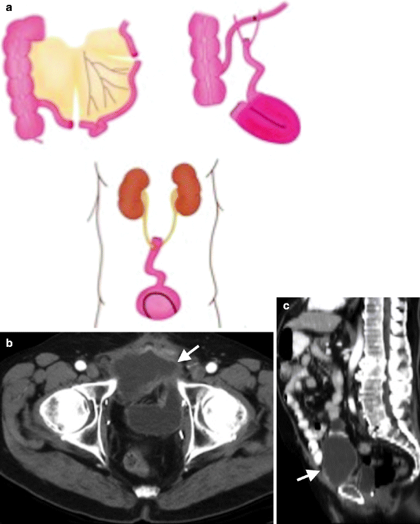 Imaging of Urinary Diversion and Neobladder | SpringerLink