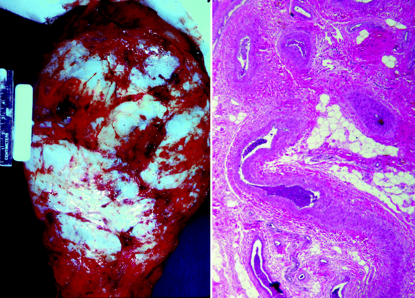 Neoplasms of the Penis and Scrotum | SpringerLink