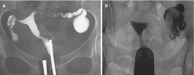 Distal Tubal Disease | SpringerLink