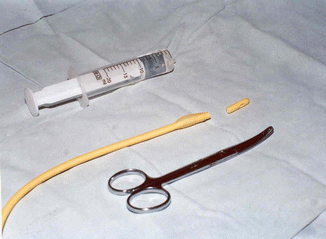 Prevention of Intrauterine Adhesions | SpringerLink