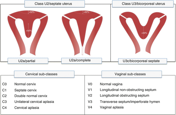 Uterine Septum | SpringerLink