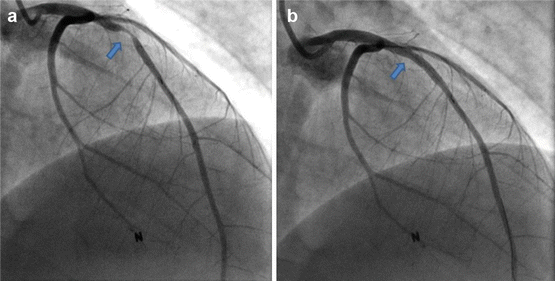 Coronary Dissection | SpringerLink