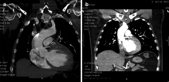 Coronary Dissection | SpringerLink
