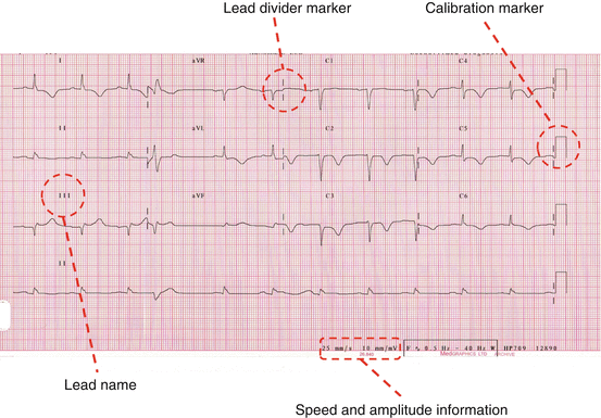 ECG Basics | SpringerLink