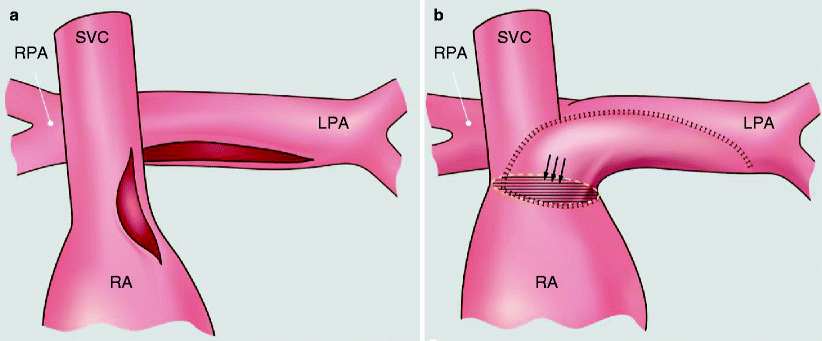 Systemic Vein to Pulmonary Artery Shunts: Glenn, Fontan, and Kawashima ...