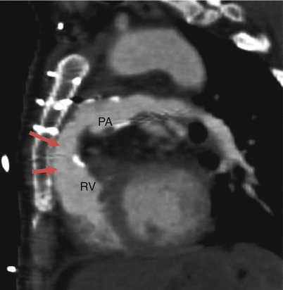 Rastelli Procedure | SpringerLink
