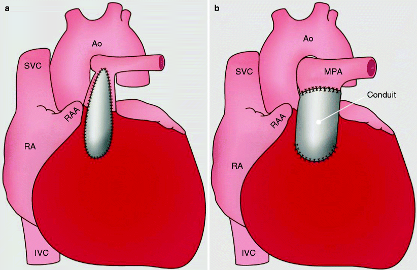 Tetralogy of Fallot Repair | SpringerLink