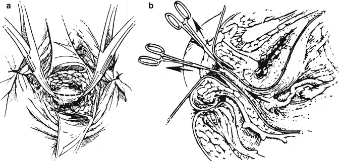 Neovagina Creation with the Use of the Pelvic Peritoneum | SpringerLink