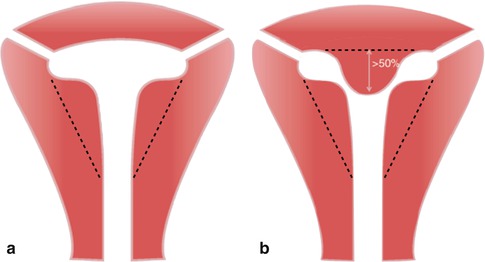 T-Shaped Uterus | SpringerLink