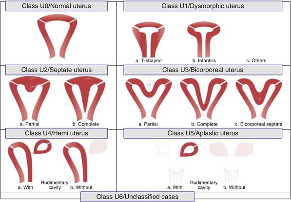 Classification of Female Genital Malformations | SpringerLink