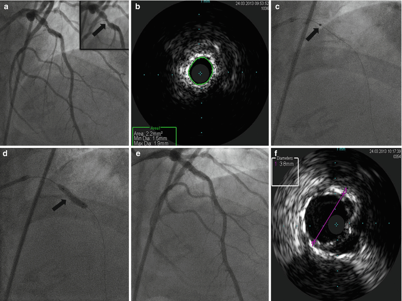 Excimer Coronary Laser Atherectomy During Percutaneous Coronary ...