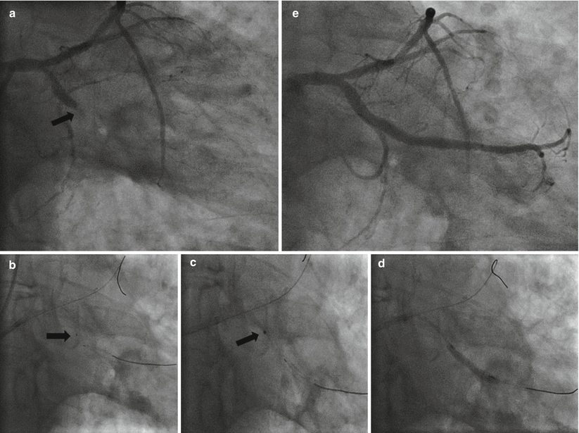 Excimer Coronary Laser Atherectomy During Percutaneous Coronary ...