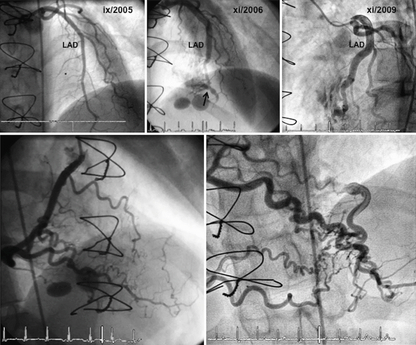 Collateral Circulation | SpringerLink