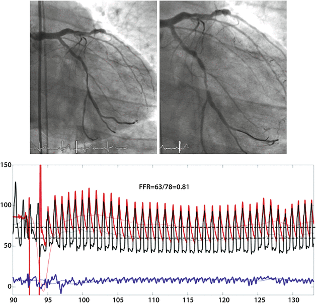 Collateral Circulation | SpringerLink