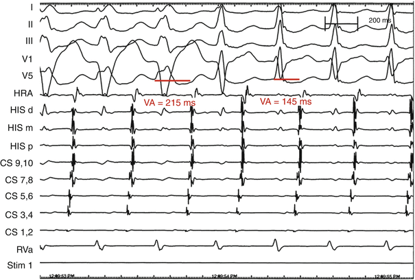 How to Differentiate Between AVRT, AT, AVNRT, and Junctional ...