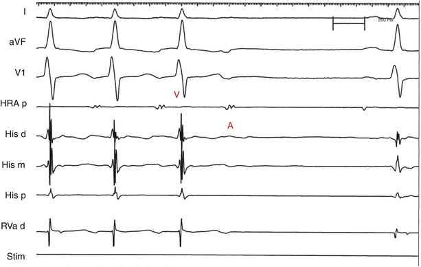 How to Differentiate Between AVRT, AT, AVNRT, and Junctional ...