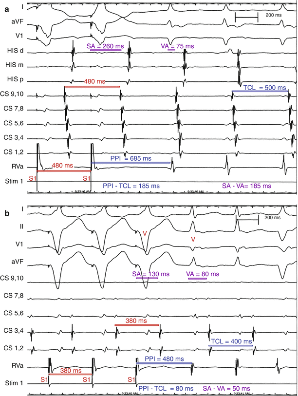 How to Differentiate Between AVRT, AT, AVNRT, and Junctional ...