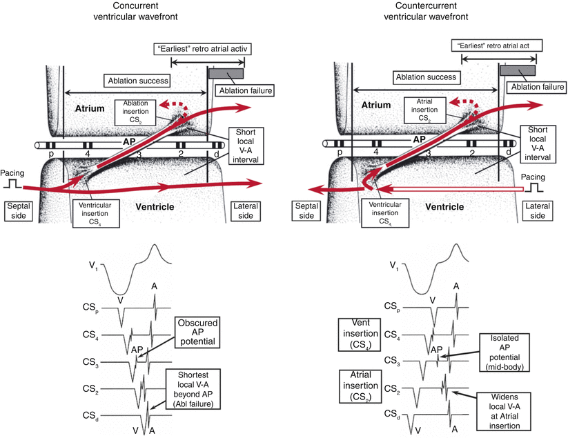Location of Accessory Pathways in WPW: What and How Should We Ablate ...