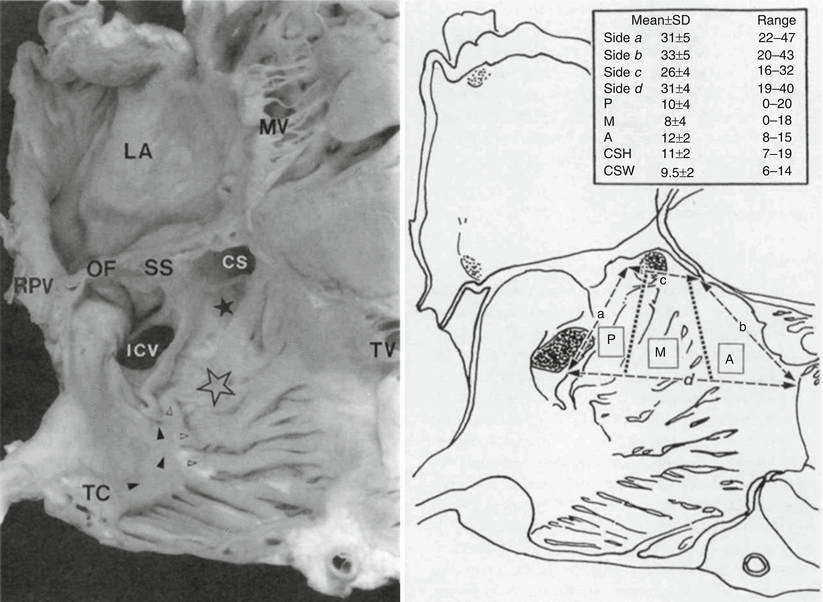 Importance of Isthmus Structure in the Right Atrium | SpringerLink