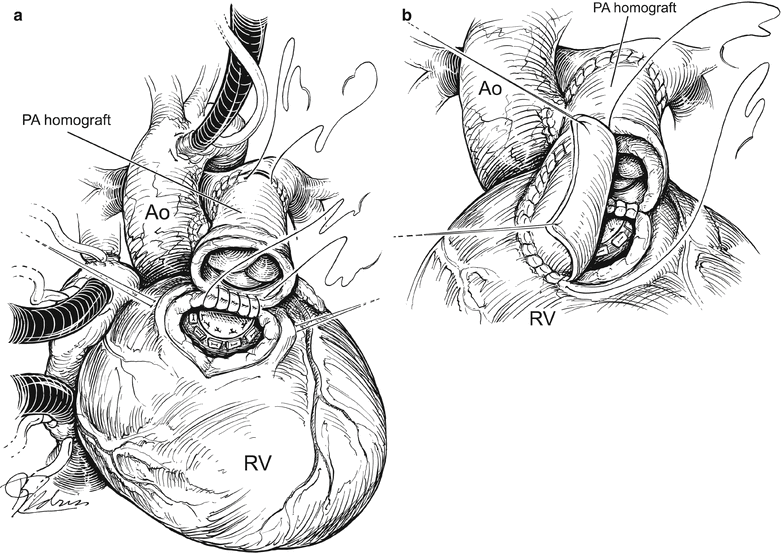 Truncus Arteriosus | SpringerLink