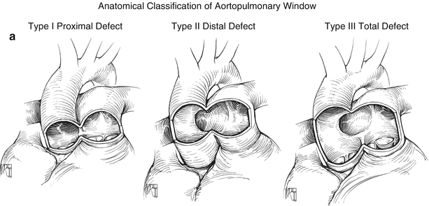 Aortopulmonary Window | SpringerLink