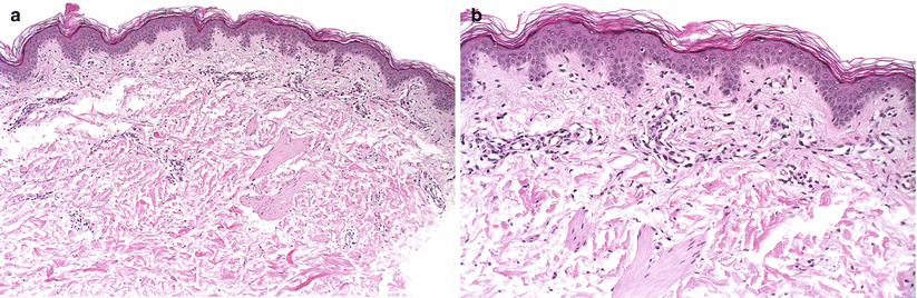 Erythema Subitum